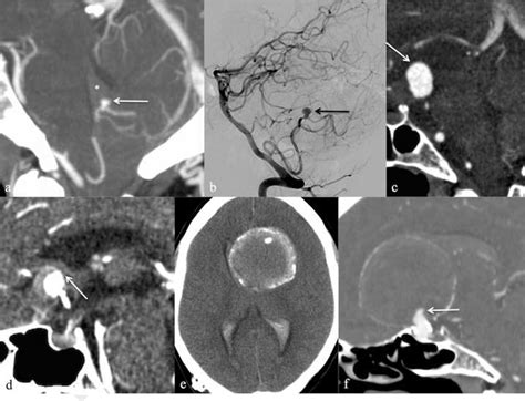 Figure 2 From Isolated Intraventricular Haemorrhage In Adults