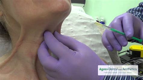 Nefertiti Neck Lift YouTube