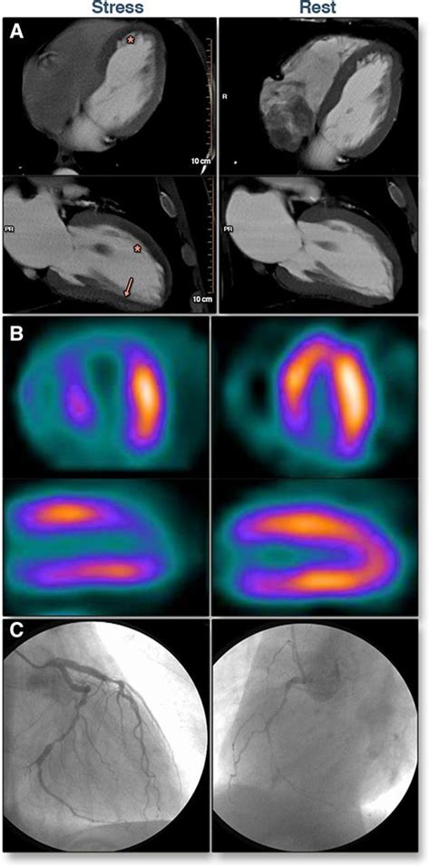 Fractional Flow Reserve And Coronary Computed Tomographic Angiography