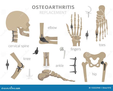 Arthritis Osteoarthritis Medical Infographic Design Joint Replacement