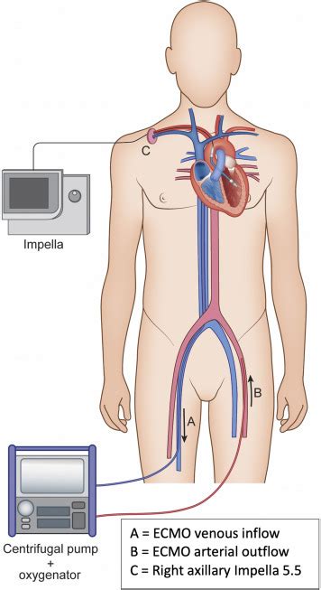 Vv Ecmo Cannula Placement