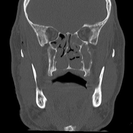 Le Fort Fracture X Ray
