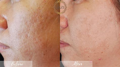 L Ser Para El Acn Y Sus Cicatrices Qazi Cosmetic Center