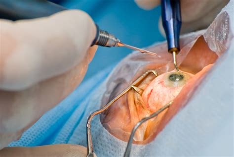 Cirurgia de Catarata o que é e quando devemos operar