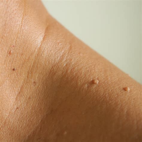Learn About Removing Skin Tags On Neck Neck Skin Tag Removal
