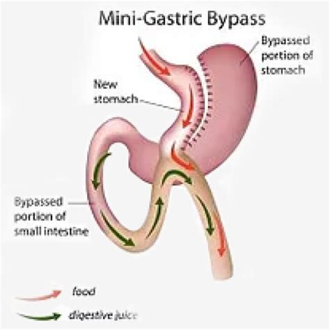 Single Anastomosis Gastric Bypass How Does It Work