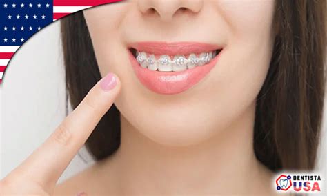Brackets Precios Cuánto cuesta ponerse brackets y cómo se clasifican