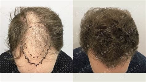 Résultats d une greffe de cheveux Avant Après Dr Bodnar