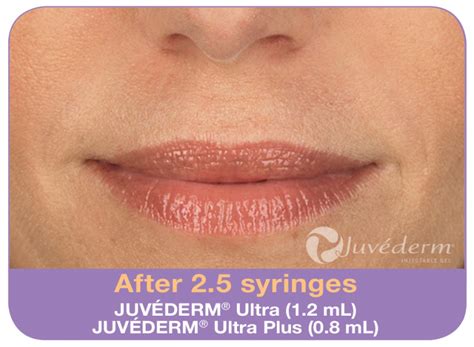 JUVEDERM Before After L Gallery L Calabasas Med Spa Calabasas Medspa