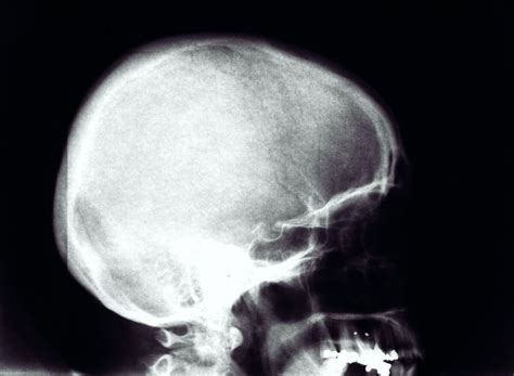 Head Trauma Appropedia The Sustainability Wiki