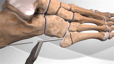 Metatarsal Fracture Repair With Arthrex Jones Screw YouTube