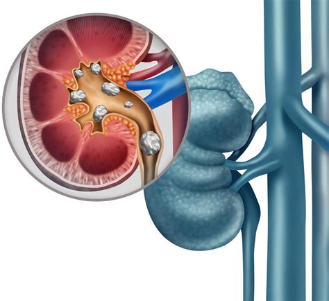 C Lculo Renal M Dico Nefrologista Dr Rui Alberto Gomes