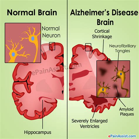 Alzheimer S Disease