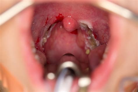 Tonsillectomy And Adenoidectomy Post Op