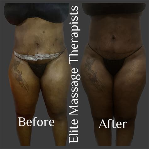 Post Op Lymphatic Drainage Massage Scheduling Elite Massage