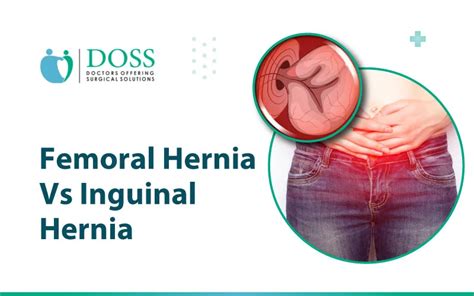Understanding The Differences Between Femoral Hernia Vs Inguinal Hernia