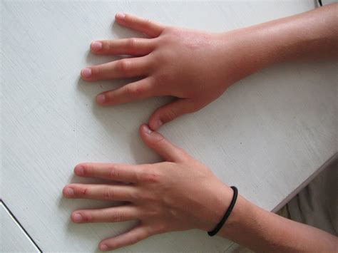 Cùng tìm hiểu những điều cần biết về 2 chân bị sưng phù là bệnh gì