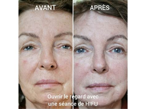HIFU Avant et après Multiesthetique fr Multiesthetique fr
