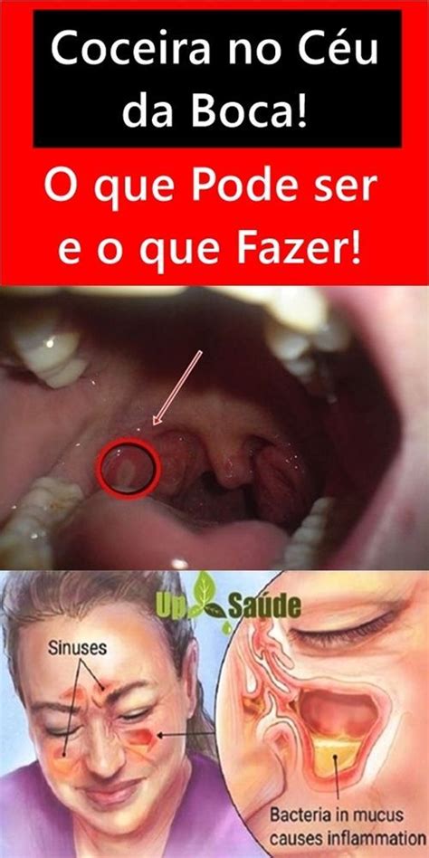 Coceira no Céu da Boca O que Pode Ser e o Que Fazer Mucus