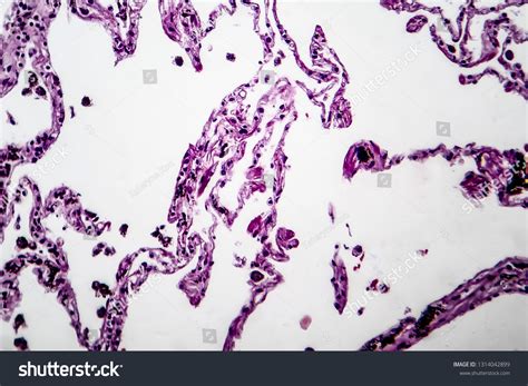Histopathology Lung Emphysema Light Micrograph Photo Stock Photo