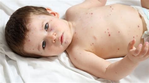 Las enfermedades contagiosas más comunes en los niños Etapa Infantil