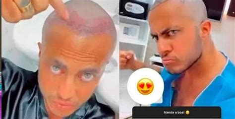 Achei Que Ia Ficar Feio Careca Diz Thammy Miranda Sobre Transplante