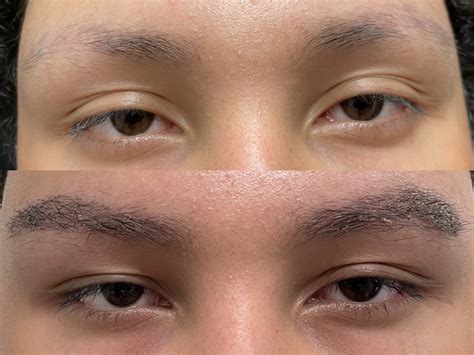Neograft Before Afters Illuminate