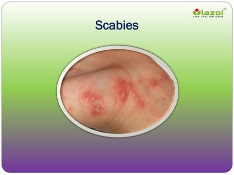 Ppt Scabies Causes Symptoms Daignosis Prevention And Treatment Powerpoint Presentation