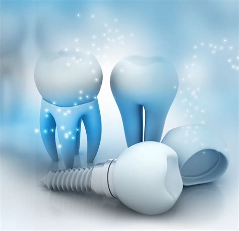 What Is Screwless Dental Implants Screw Implant Or Bonding