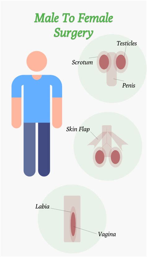 How Much Does Male To Female Mtf Surgery Cost In 2023 Clinicspots
