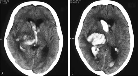 Hemorragia Cerebral