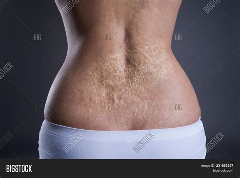 Severe Back Scars