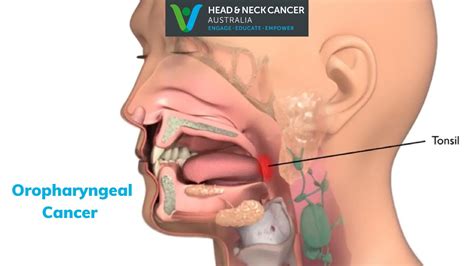 Oropharyngeal Cancer What Is It Symptoms And Treatment Head And
