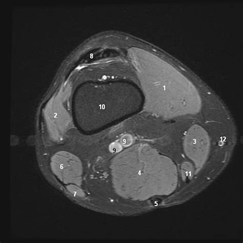 Knee Muscle Anatomy Mri Knee Anatomy Mri DriverLayer Search Engine