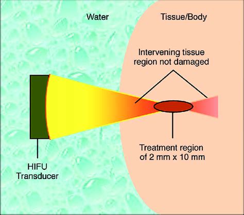 A High Intensity Focused Ultrasound Beam S HIFU Effect At Focus In