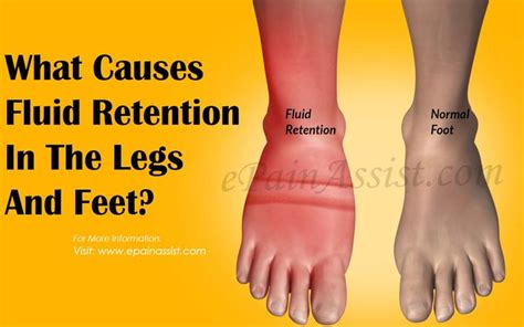 Water Retention In Ankles And Legs