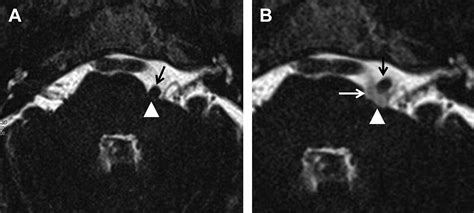 Imaging Of Vascular Compression Syndromes Radiologic Clinics