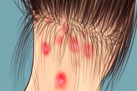 Conhe A Os Sintomas Da Fibromialgia Dor Muscular E Como Lidar