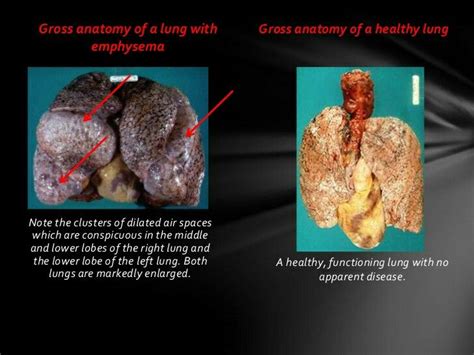 Emphysema Lung Vs Normal Lung