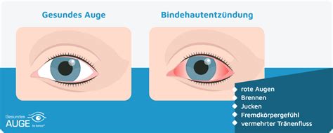 Bindehautentzündung Symptome und Behandlung
