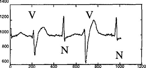 figure 1 from previous identification of qrs onset and offset is not essential for classifying