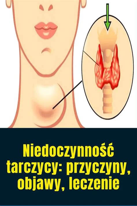 Niedoczynność tarczycy przyczyny objawy leczenie
