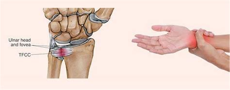 Triangular Ligament