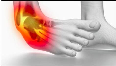 Entorse De Tornozelo Fisioterapia Cl Nica De Fisioterapia E Pilates