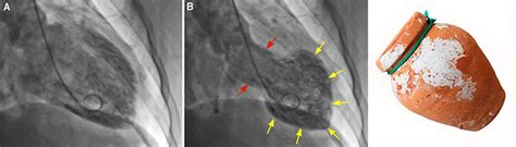 Takotsubo Syndrome The Broken Heart Syndrome