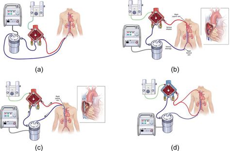 Extracorporeal Membrane Oxygenation Beyond Conventional Indications