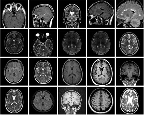 diagnostics free full text refined automatic brain tumor classification using hybrid