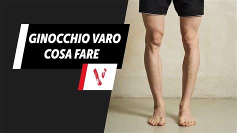 Ginocchio Varo Esercizi Correttivi YouTube