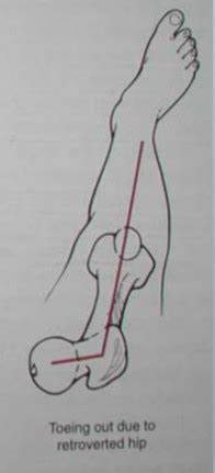 Hip Pathologies Flashcards Quizlet