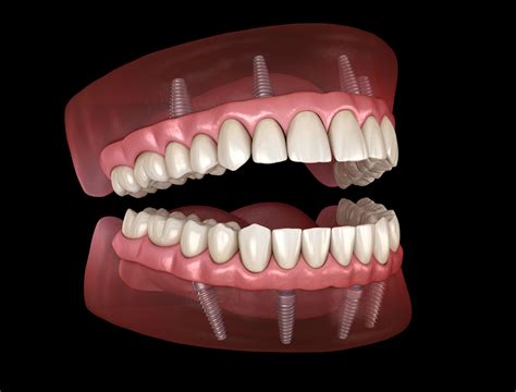All On 4 Dental Implants Memphis TN Southern Dental Implant Center